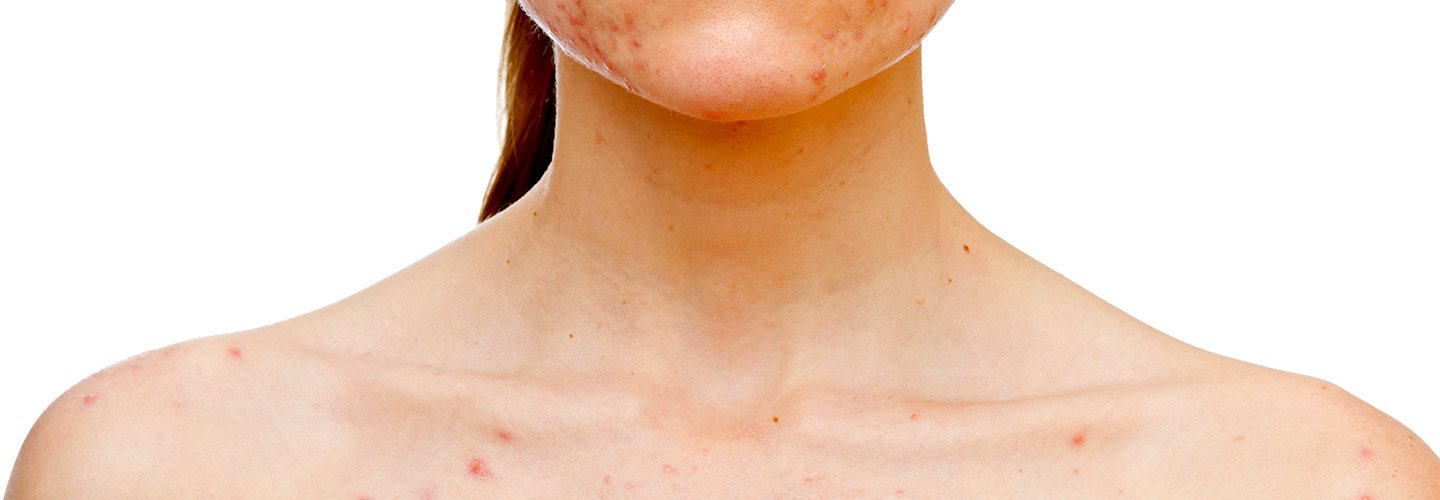 Dermatite da stress: sintomi, cause, sintomi e rimedi | Eucerin