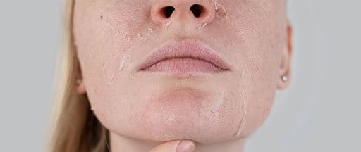 Cuide da Pele Ressecada no Rosto com Eucerin® - Hidratação e Proteção