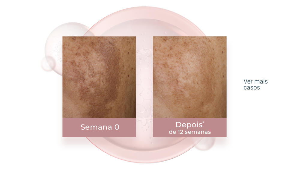 Thiamidol: O Ingrediente Anti-Manchas Mais Efetivo | Eucerin®