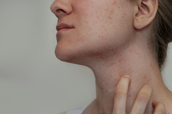 Boutons dans le cou : causes & signification | Eucerin