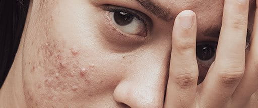 Acné en el Rostro: cómo tratar y prevenir | Eucerin®