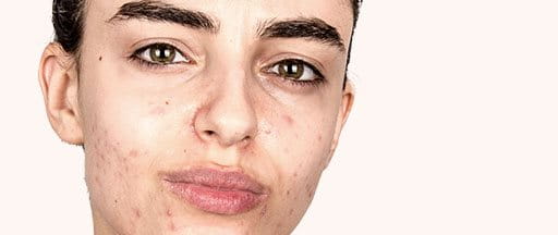 Acné en facial: causas, síntomas y tratamientos | Eucerin®