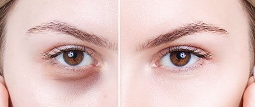 ¿Cómo eliminar las bolsas y ojeras en los ojos? | Eucerin