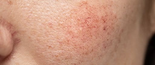 Piel sensible y seca: causas y tips para cuidarla | Eucerin®