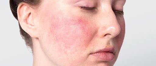 ¿Qué es la dermatitis atópica en la cara? | Eucerin