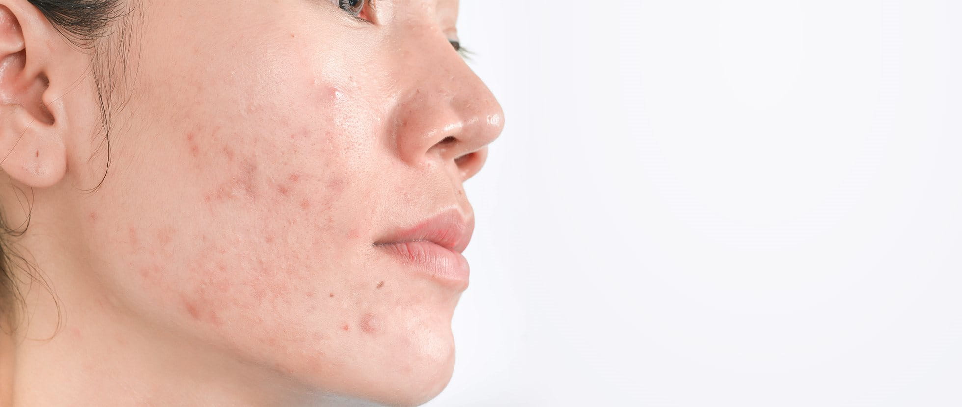 Hyperpigmentation Caused By Inflammation | Eucerin