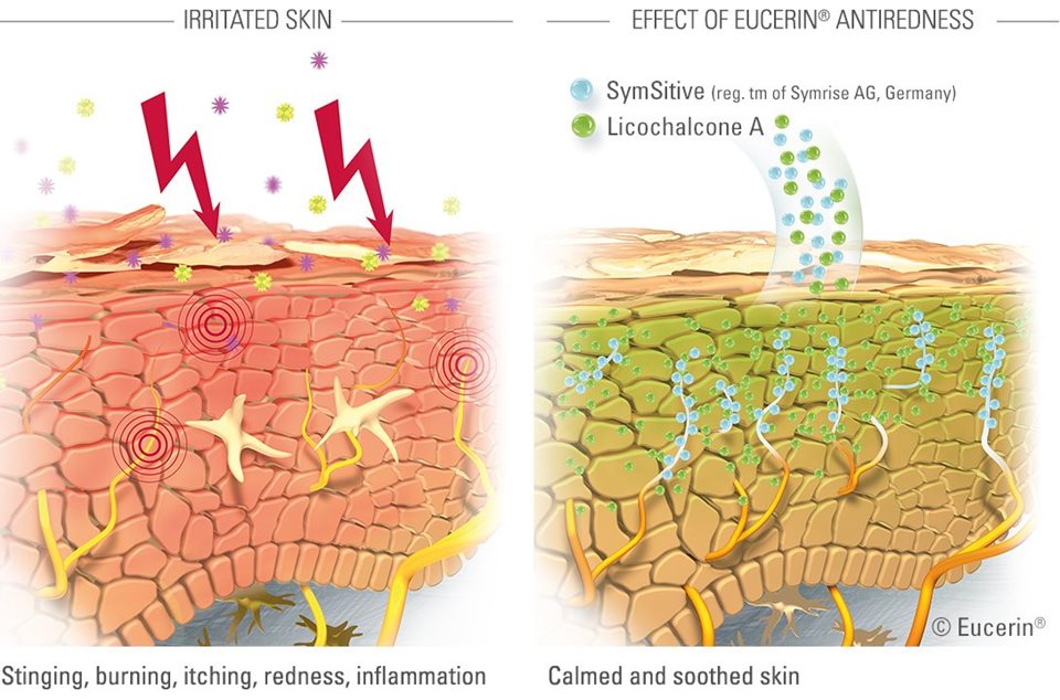 Eucerin: About skin| Rosacea and Couperose-prone skin