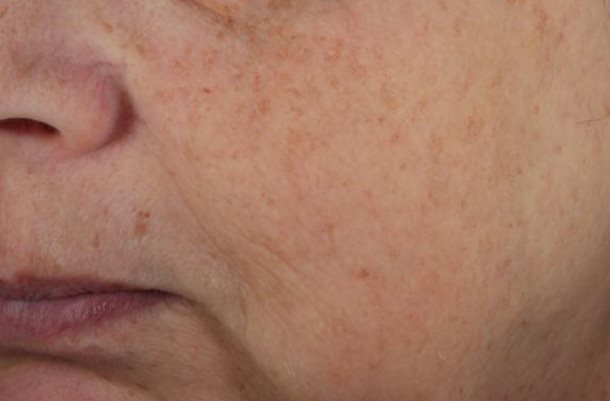 Eucerin: Pelle Ipersensibile | Eucerin ANTI-ROSE Trattamento ...