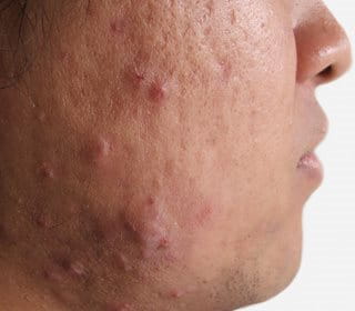 Acne-Prone Skin - Causes, Triggers, Symptoms and Advice - Eucerin