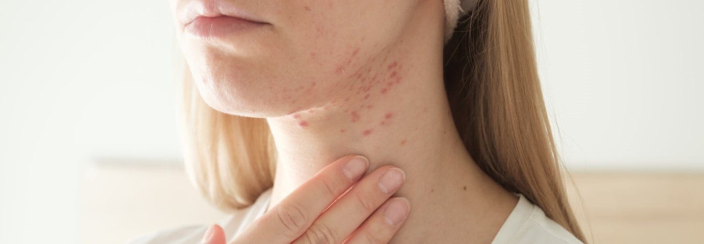Pickel am Hals – Ursachen erkennen und behandeln | Eucerin