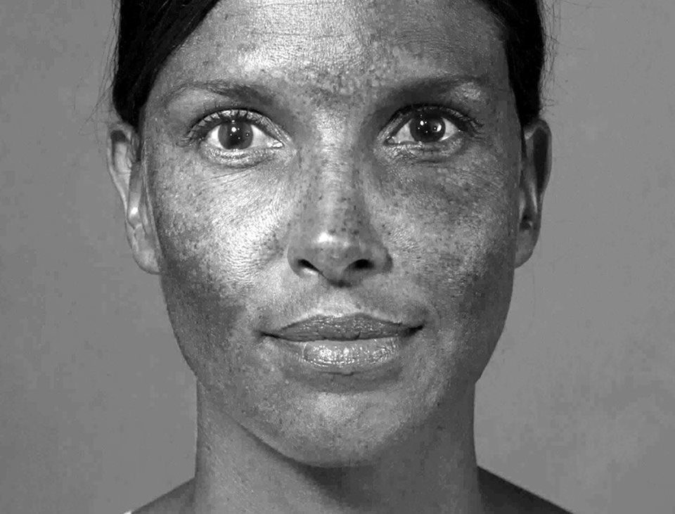 Photoaging: Hautalterung durch UV-Strahlen