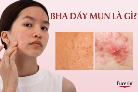 Dùng BHA Bao Lâu Đẩy Mụn? Phân Biệt BHA Đẩy Mụn & Bùng Mụn | Eucerin
