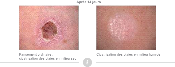 Permettre aux plaies de cicatriser dans un milieu humide est bénéfique ...