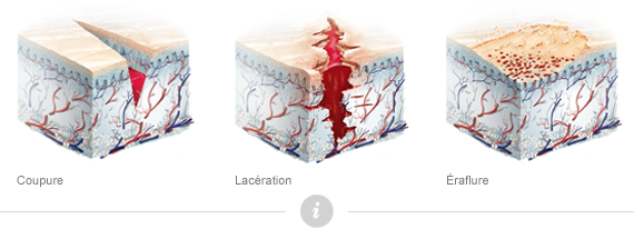 Physiologie de la cicatrisation
