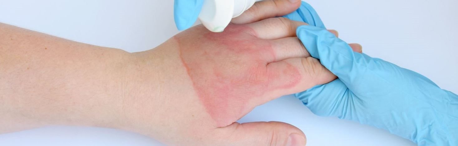 Verbrennungen richtig behandeln