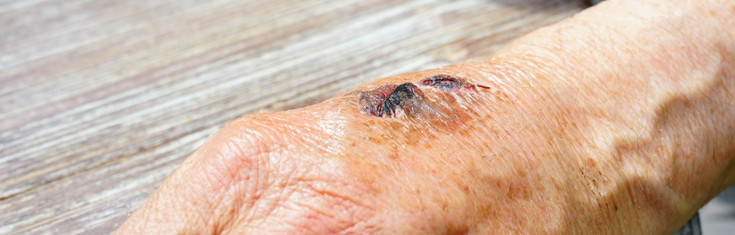 What are scabs? | Elastoplast