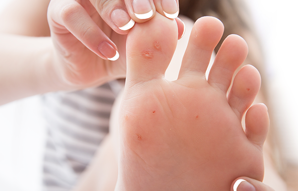 Callos en los pies: causas y cómo tratarlos | Curitas®