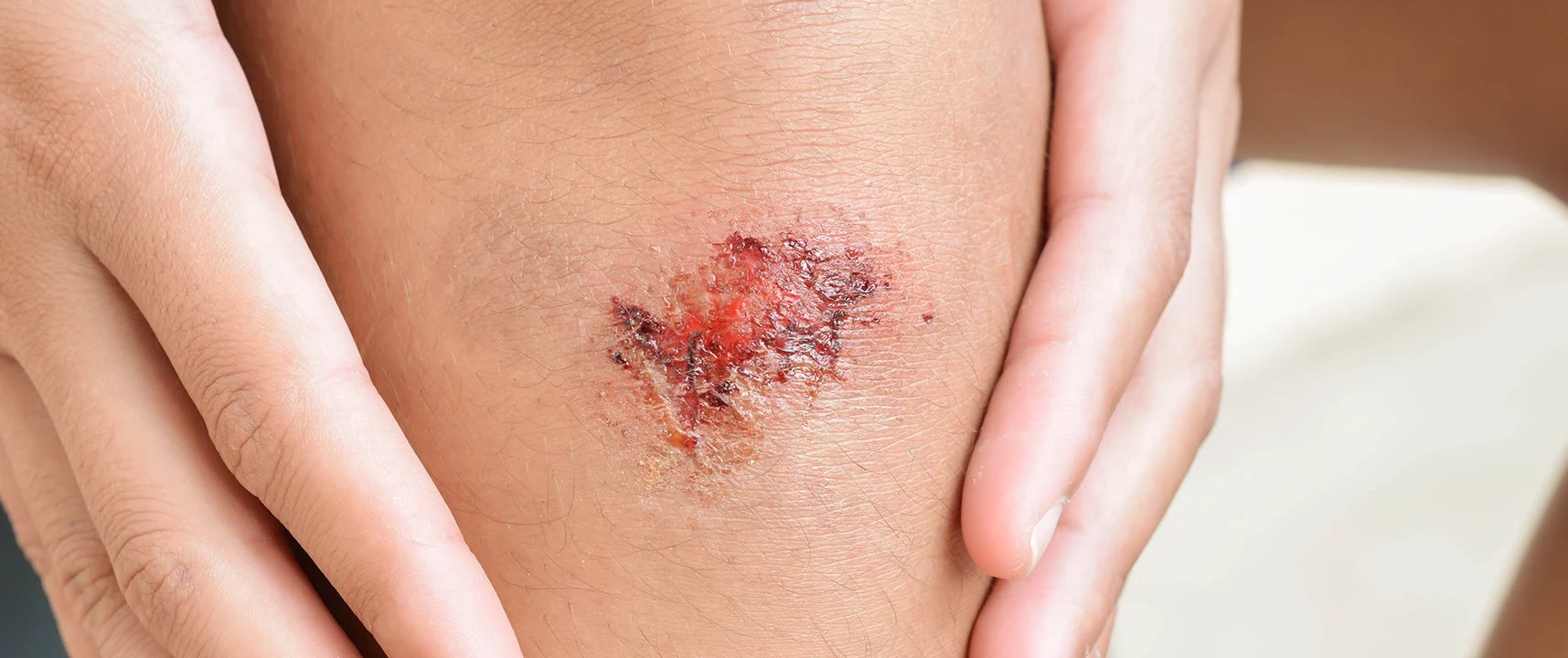 Cara Mengobati Luka Bernanah agar Tidak Semakin Parah